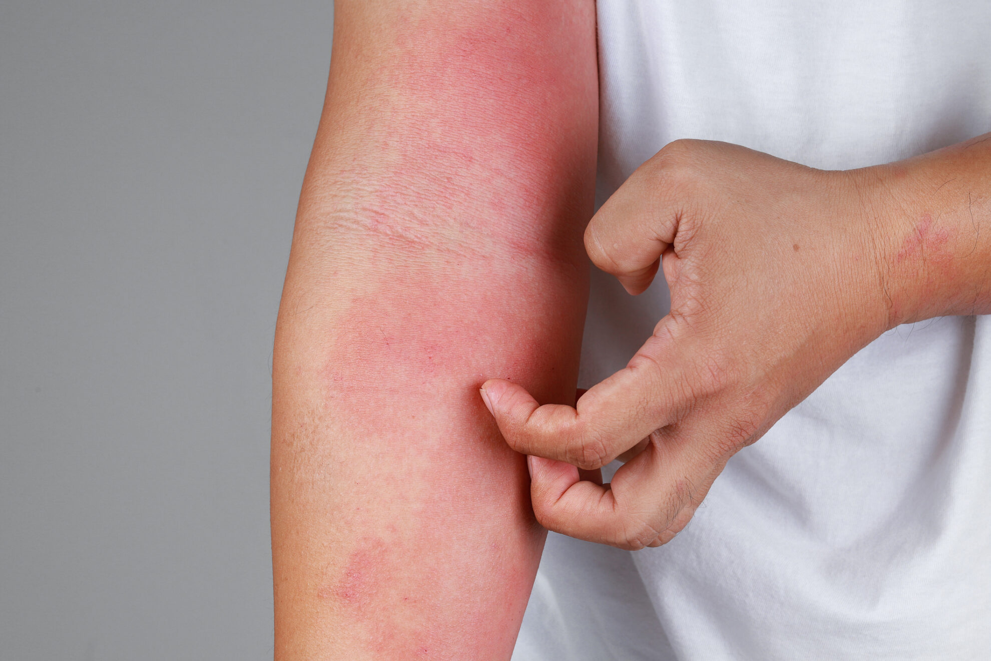 What Causes Eczema Flare-Ups in Fall and How to Manage