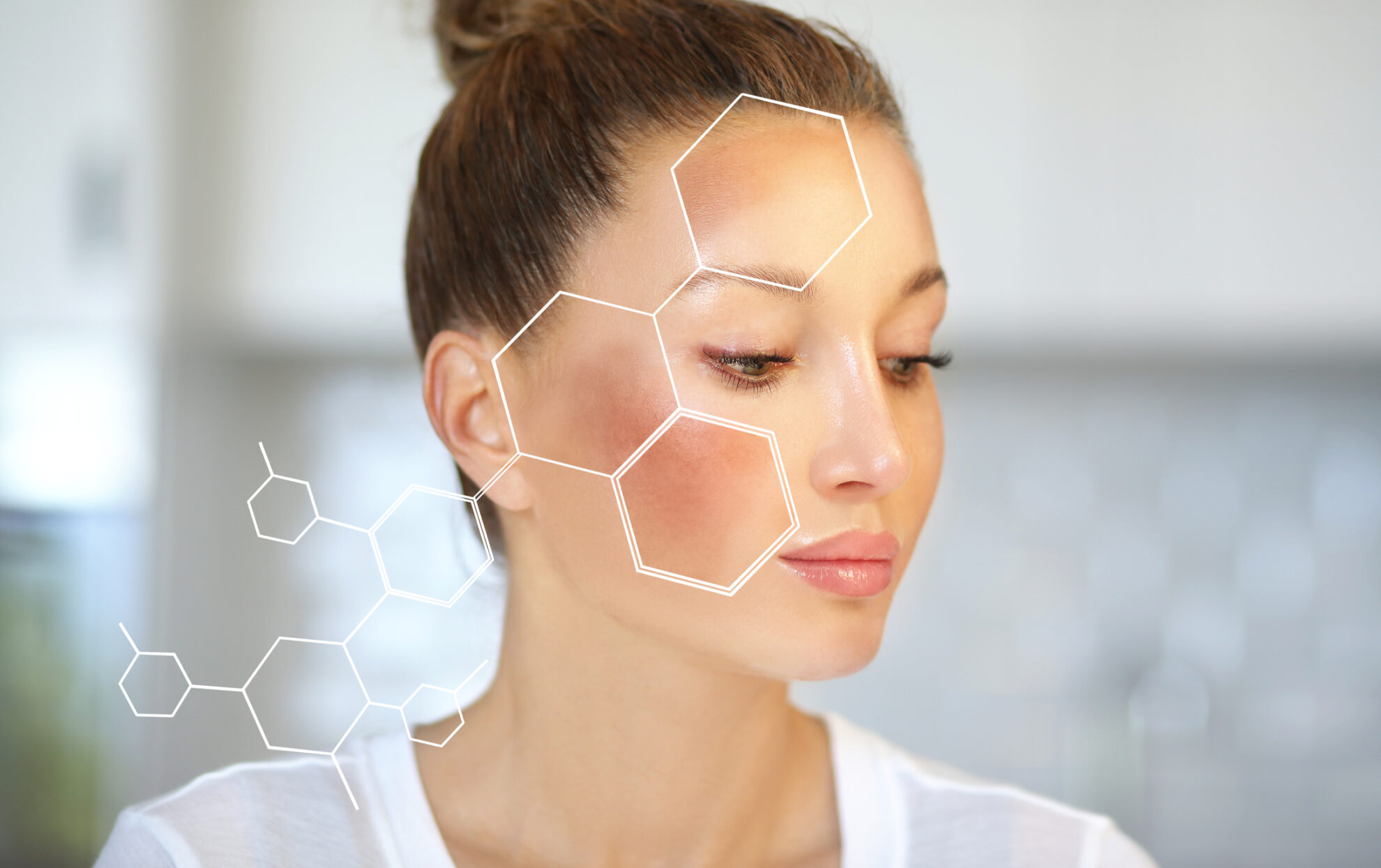 What Is the Best Treatment for Melasma? | Swinyer Woseth Dermatology