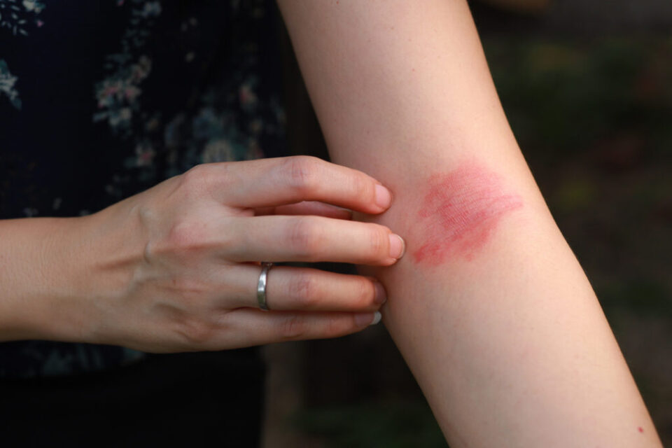 Bacterial vs Viral Skin Infections- How Can You Tell Which is Which ...