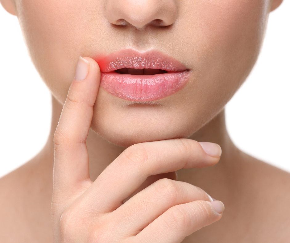 What You Need to Know About Cold Sores | Swinyer Woseth Dermatology