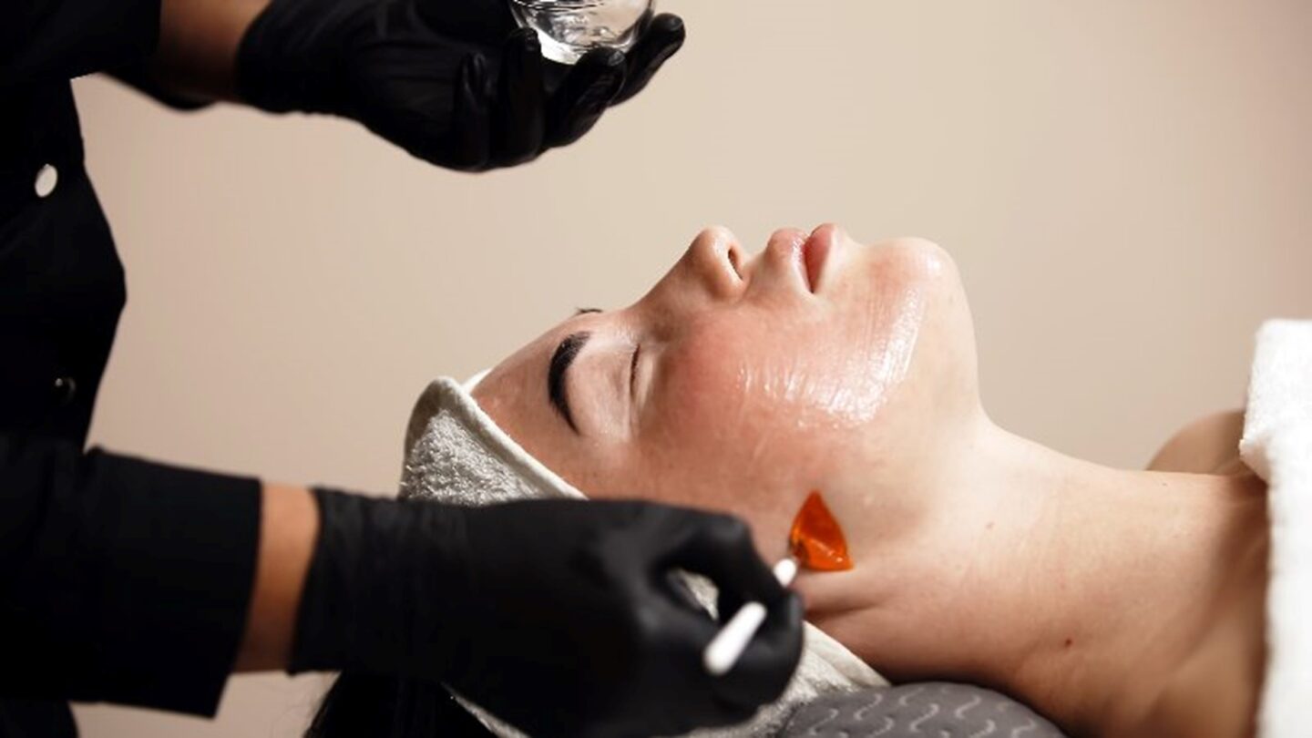 Chemical Peels for Skin Resurfacing in SLC, UT